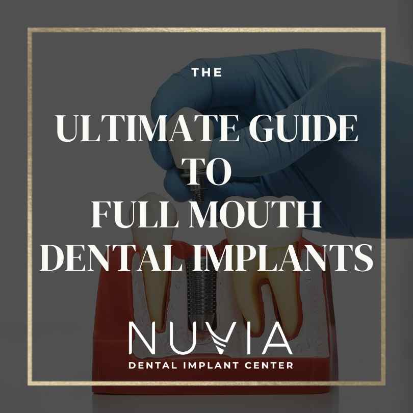 The Ultimate Guide To Full Mouth Dental Implants